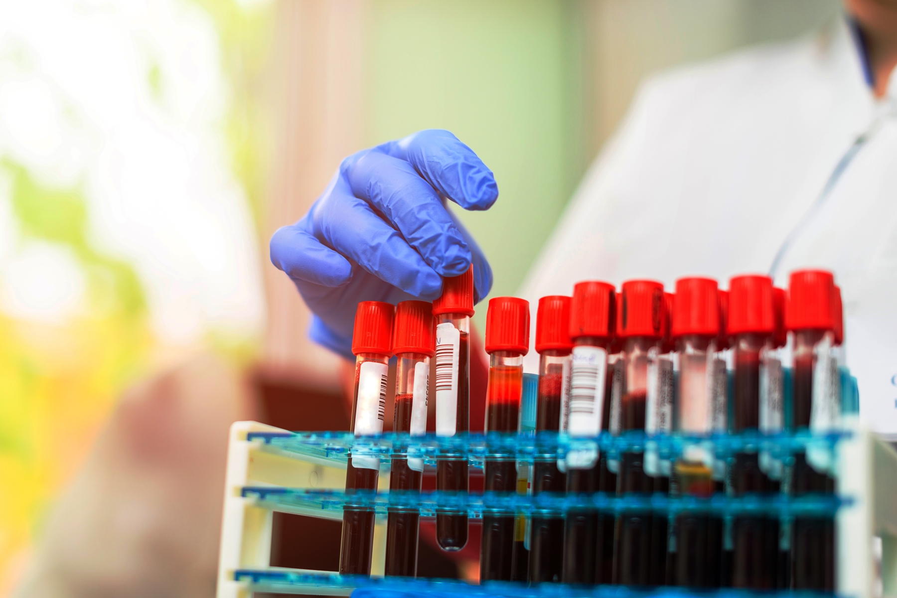 MSU (mid stream urine) sample Collection | Meadowbridge Surgery